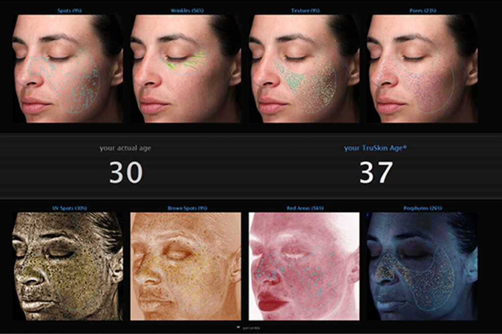 VISIA Facial Assessment Buffalo, NY | Buffalo Aesthetics