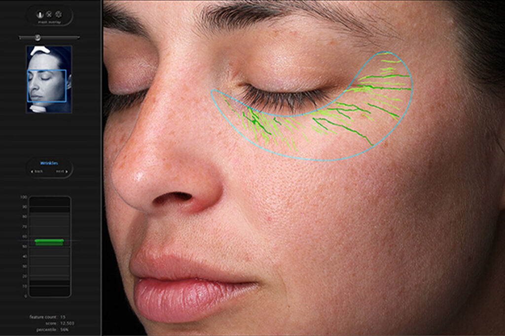 VISIA Facial Assessment Buffalo, NY | Buffalo Aesthetics