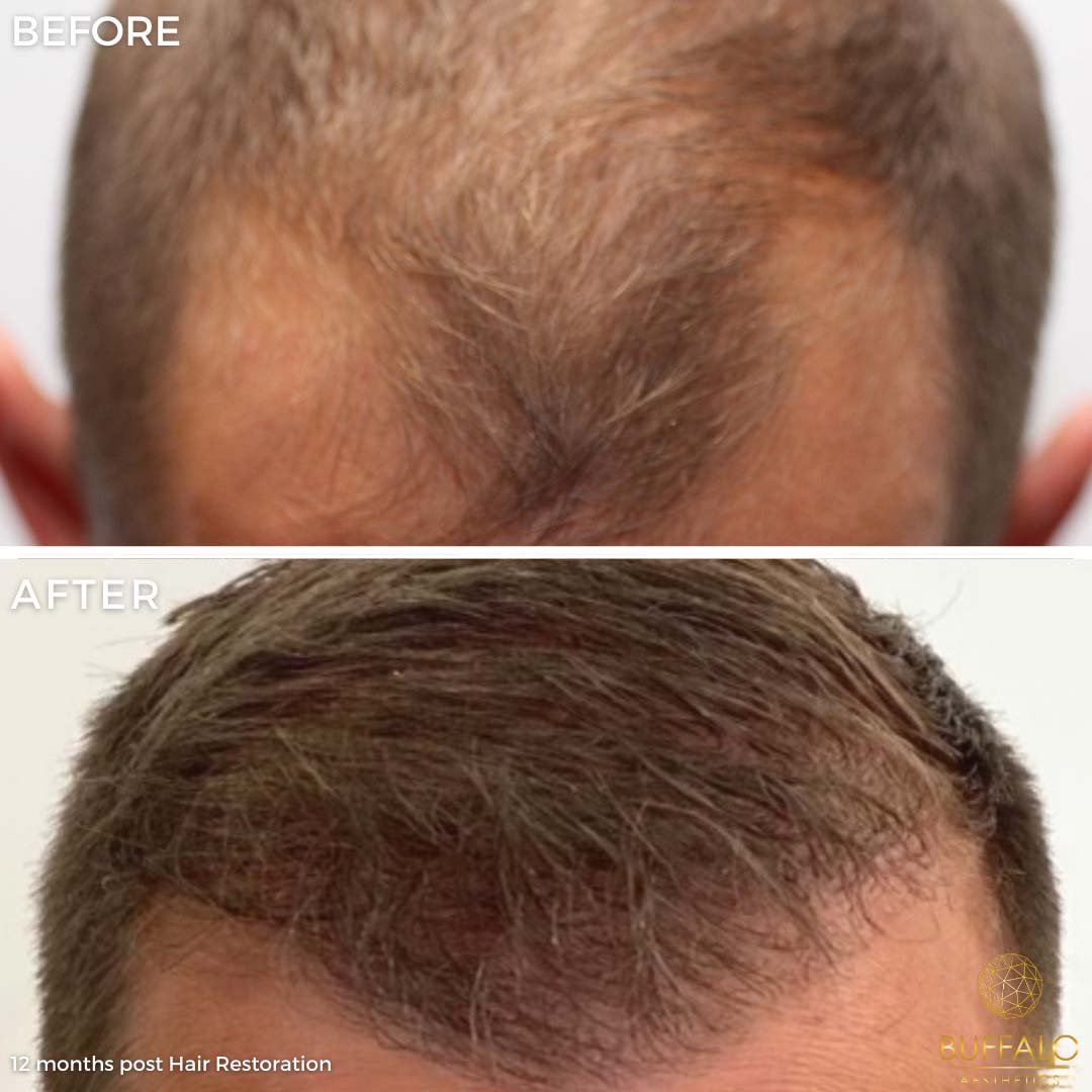Hair Restoration Buffalo, NY | Buffalo Aesthetics